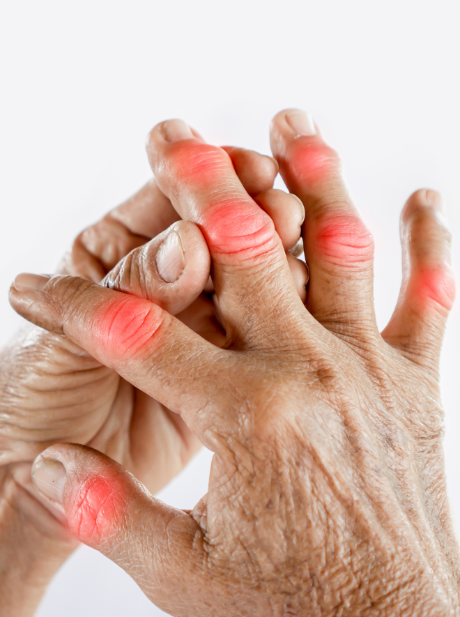 Precio de tratamiento para gota aguda | Dr. Alberto Mariano Saucedo ...